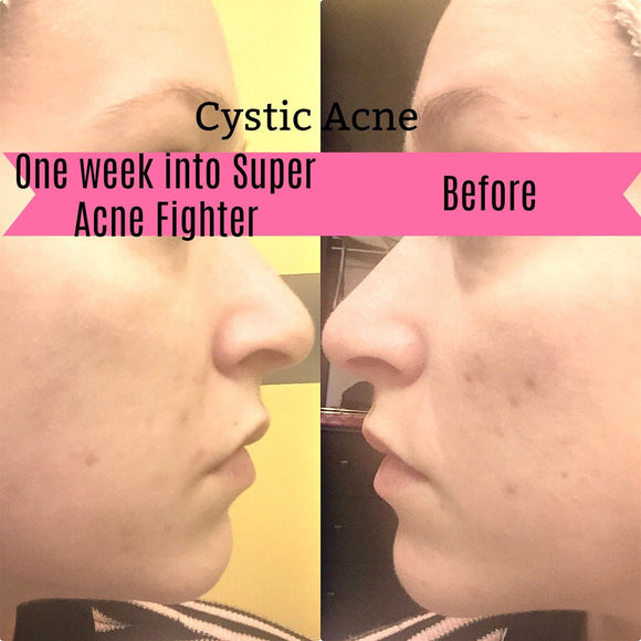 Super Acne Fighter / Organic Acne Treatment / Acne / Essential Oils ...