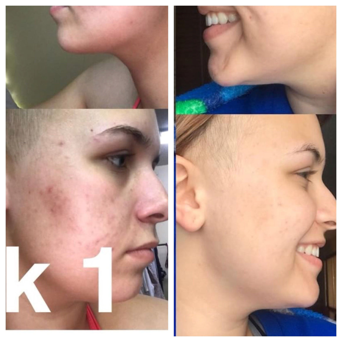 Super Acne Fighter / Organic Acne Treatment / Acne / Essential Oils ...